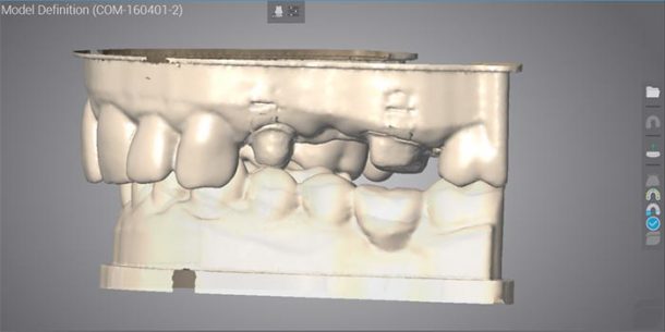 Bridge - Dental Wings - Dental Wings